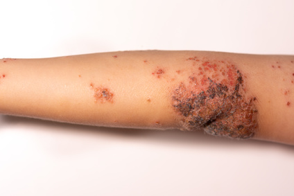 Impetigo (Eiterflechte) - Ursachen, Beschwerden & Therapie | Gesundpedia.de