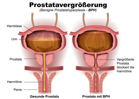 Prostatahypertrophie - Ursachen, Beschwerden & Therapie | Gesundpedia.de