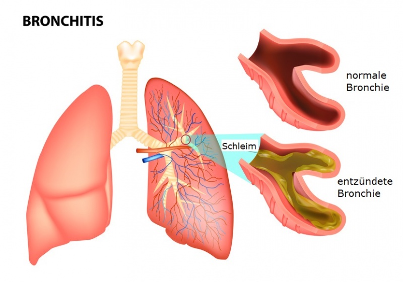 Datei:Bronchitis.jpg - Gesundheits-Ratgeber & Lexikon | Gesundpedia.de Datei:Bronchitis.jpg - Gesundheits-Ratgeber & Lexikon | Gesundpedia.de