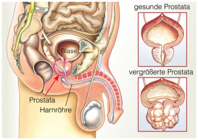 Benigne Prostatahyperplasie - Ursachen, Beschwerden & Therapie | Gesundpedia.de