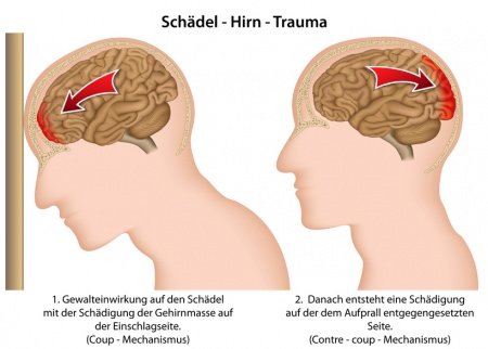 Schädel-Hirn-Trauma - Ursachen, Beschwerden & Therapie | Gesundpedia.de